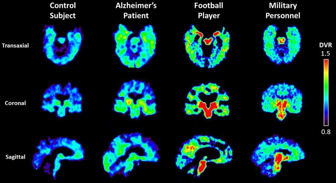 Scientists Hunt For A Test To Diagnose Chronic Brain Injury In Living ...