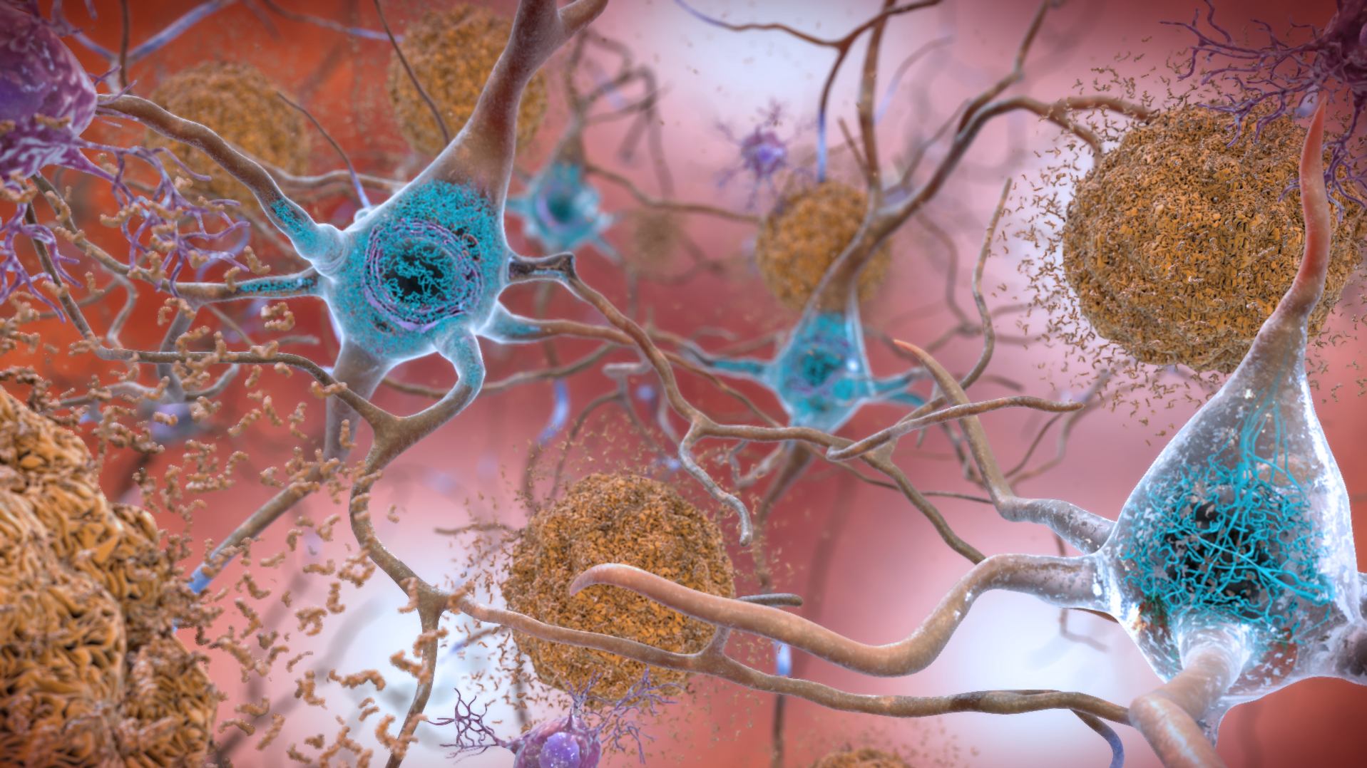 New Markers For Alzheimer s Disease Could Aid Diagnosis And Speed Up Drug Development WJCT NEWS