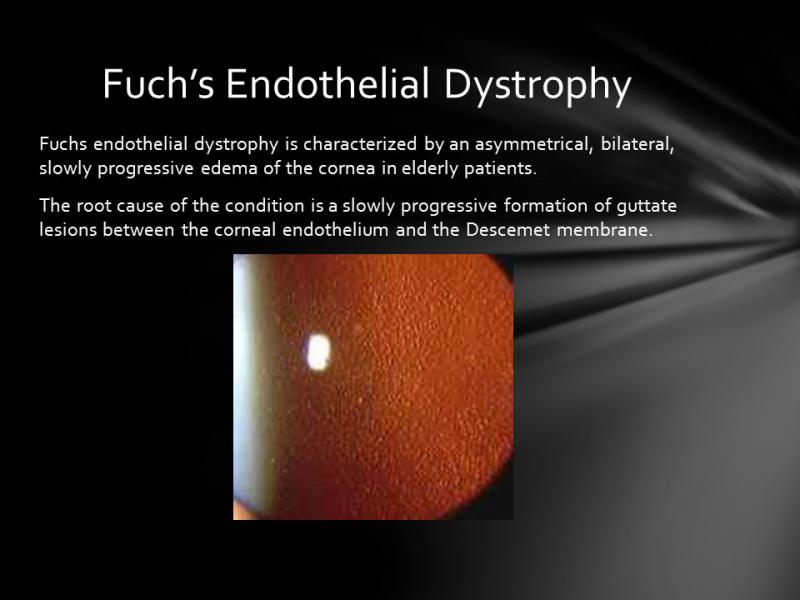 So you've just been diagnosed with Fuch's Corneal Endothelial Dystrophy ...